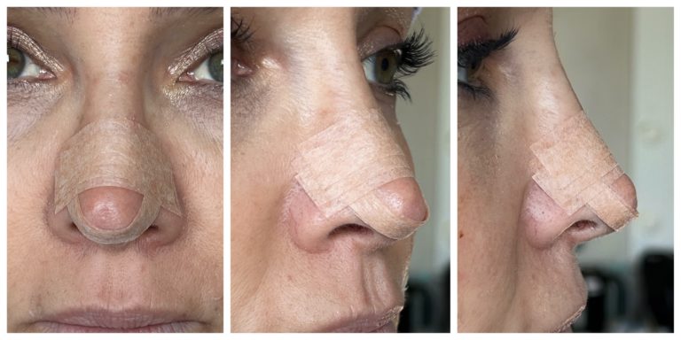 Taping nasal après une rhinoplastie - Dr Frédéric LANGE